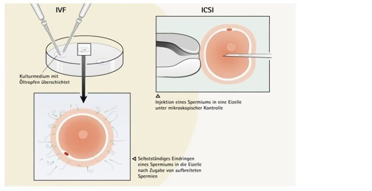 Künstliche Befruchtung Intracytoplasmatische Spermieninjektion (ICSI ...